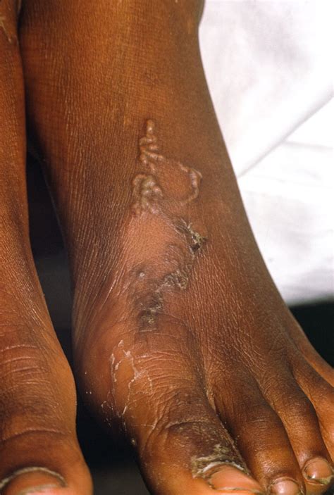 Hookworm Infection Infectious Diseases Merck Manual Professional