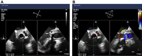 A Transesophageal Echocardiographic Short Axis SAX And Long Axis Download Scientific