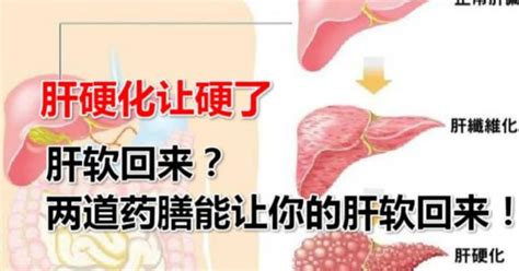 肝硬化怎樣能讓硬了的肝軟回來這兩道藥膳能讓你的肝軟回來