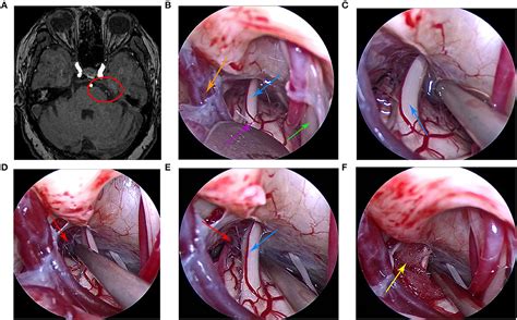 Microvascular Decompression