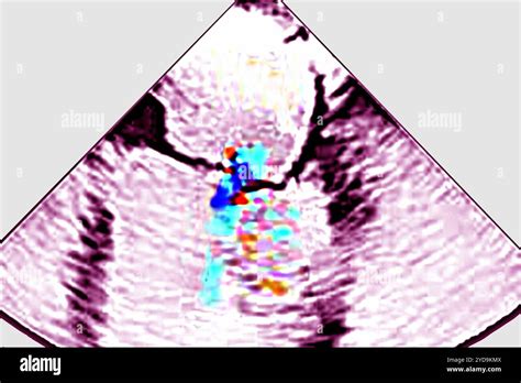 Ischemic Mitral Insufficiency Mi Pathology Of The Left Ventricle