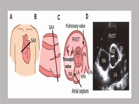 How To Read Echocardiography Of Heart Pptx
