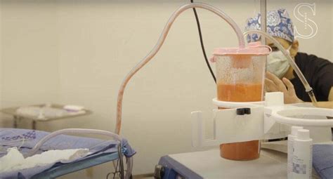 Liposuction Before And After A Comprehensive Guide