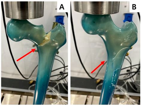 Prophylactic Femoral Neck Fixation In An Osteoporosis Femur Model A