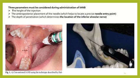 Inferior Alveolar Nerve Pptx