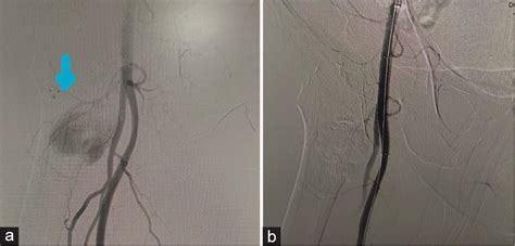 Complications Of PCI And Its Management Indian Journal Of Cardiovascular Disease In Women