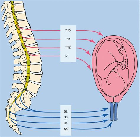 Neuraxial Analgesia In Obstetrics Anesthesia Key