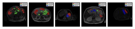 Radiology Machine Learning Multi Image Segmentation With Transunet
