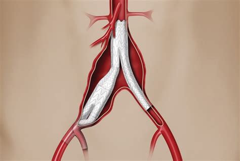 Vascular Embolization Can Be Useful For Blocking Blood Flow To An