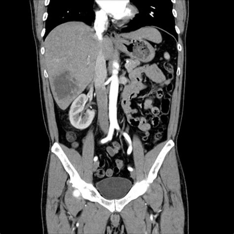 Differential Diagnosis Of Hepatic Abscess