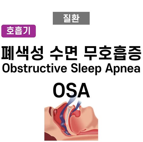 폐색성 수면 무호흡증 Obstructive Sleep Apnea 의학당
