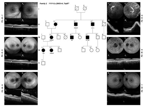 Multimodal Study Of Prph2 Gene Related Retinal Phenotypes