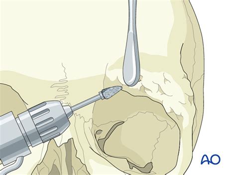 Partial Ostectomy And Contouring For Extensive Fibrous Dysplasia