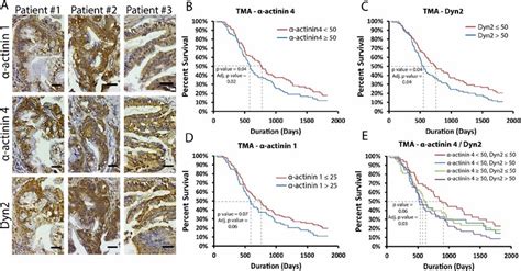 Dyn2 And α Actinin 4 Overexpression In Pdac Patients Is Correlated With