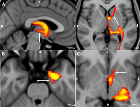 Population Connectivity Maps Of The Amygdala Clusters A The Basal Download Scientific