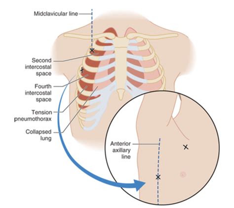 Procedures Flashcards Quizlet