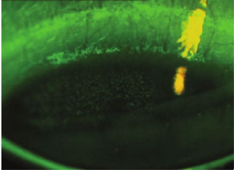 Example Of Superior Lens Edge And Limbal Conjunctival Fluorescein Download Scientific Diagram