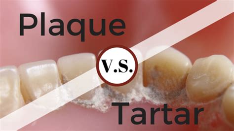 Plaque Vs Tartar Whats The Difference Britt Dental Center