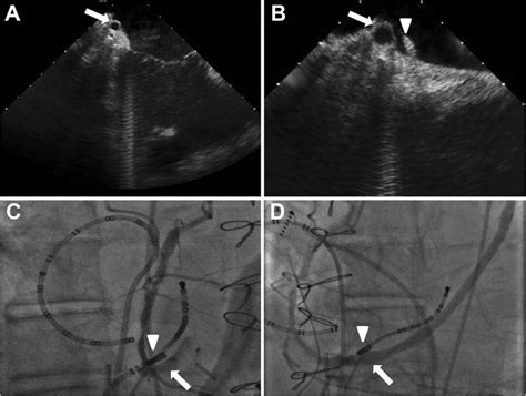 An Unexpected Intracardiac Echocardiography Finding On The Cavotricuspid Isthmus Pmc