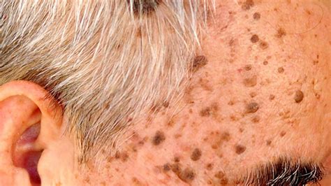 Benign Skin Growths Treatment In Singapore Lumine Dermatology And Laser