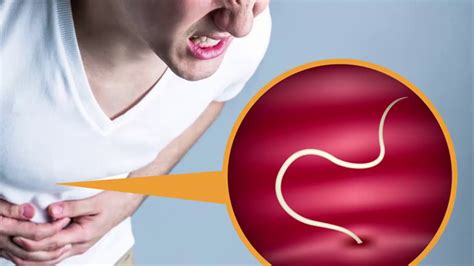 Глисты у человека фото симптомы лечение Признаки гельминтоза Youtube