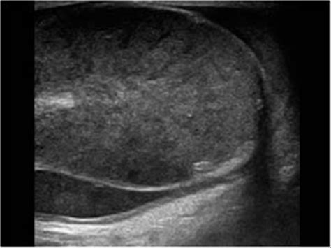 Urinary Tract And Male Reproductive System 2 3 Scrotum Case 2 3 7 Testicular Torsion