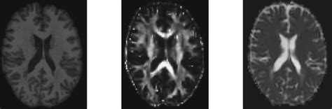 Left Mr T1 Image Middle Dt Fa Image Right Dt Md Image Download