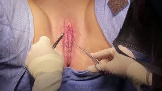 Labiaplasty Surgery Letmejerk