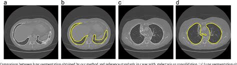 Figure 11 From An Automated Lung Segmentation Approach Using Bidirectional Chain Codes To