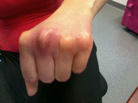 Bruised Black Knuckles