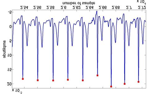 PQRST Complex Segmentation Ecg Signal With Marked R Pointers