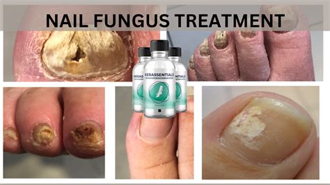 Kerassentials Oil Supplement Facebook Kerassentials Oil Supplement Facebook