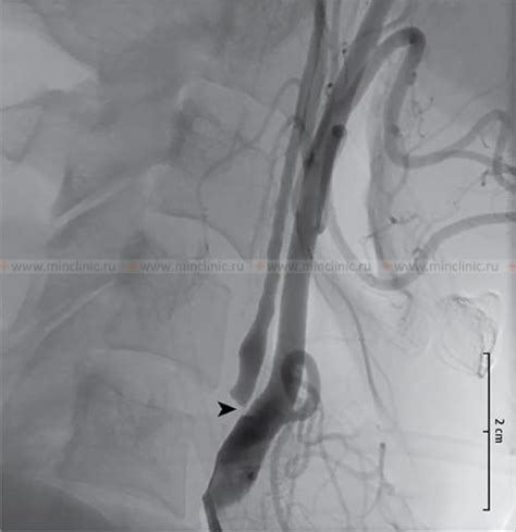 Internal Carotid Artery Occlusion — Stroke And Tia Risk Min Clinic