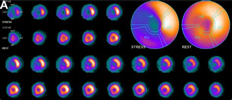 Resolution Of Inferior Wall Ischemia After Successful Revascularization Of Lad Lesion The Value