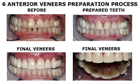 How Long Does Veneers Process Take At Jack Oconnell Blog