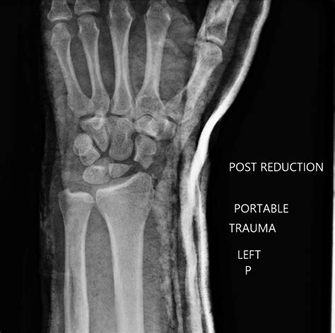 Scaphoid Dislocation