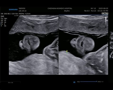 임신 17주차 25주차 태아 정밀검사 임신성 당뇨 검사 입체 초음파 검사 후기 네이버 블로그