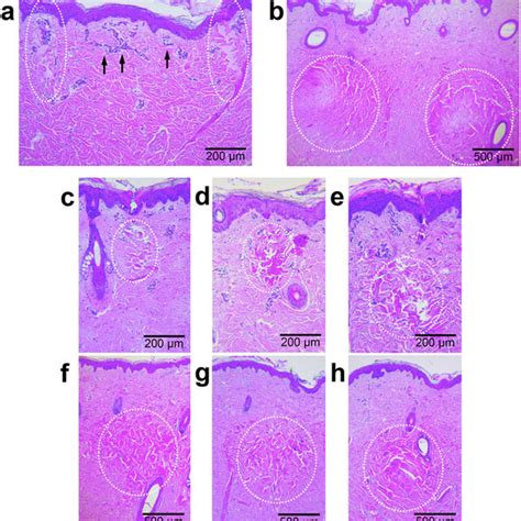 Effect Of 2 Mhz Invasive Bipolar Rf Treatment Using Non Insulated