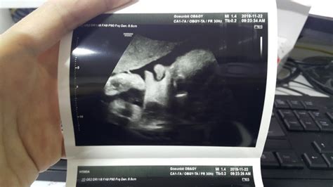 잠실산부인과 송파고은빛산부인과 33주 진료후기 네이버 블로그