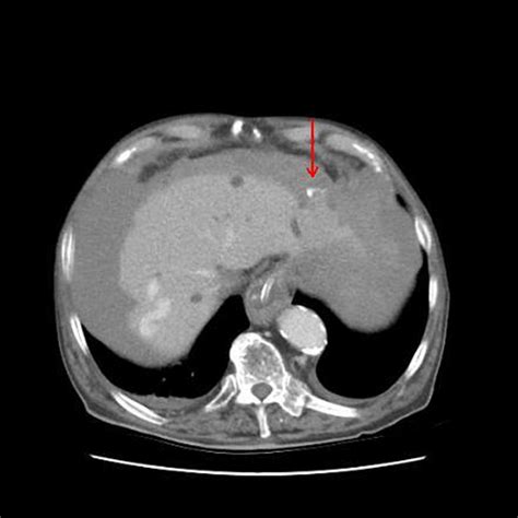 Ct Revealed No Features Of Pulmonary Infection Liver Surface Download Scientific Diagram
