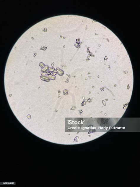 소변 침전물에서 나온 스트루바이트 결정의 현미경 보기 마그네슘 암모늄 인산염 결정 고양이 하부 요로 질환 유발 Drug에 대한 스톡 사진 및 기타 이미지 Istock