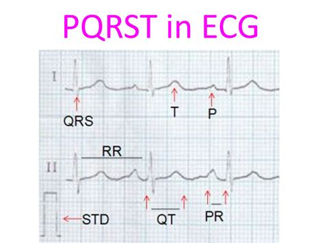 Pqrst In Ecg The Waves And Intervals In A Normal Ecg