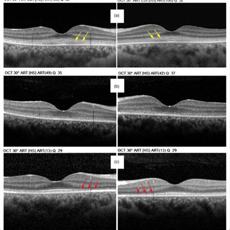 Macular Oct Of The Right And Left Macula A Initial Presentation