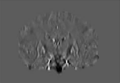 Figure 1 From The Visualization Of The Subthalamic Nucleus With Quantitative Susceptibility