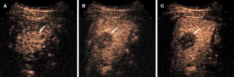 Combined Hepatocellular Cholangiocarcinoma In A 77 Year Old Man With Download Scientific