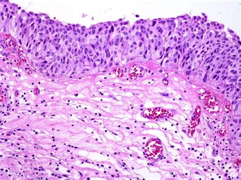 Cap Protocol Bladder Pptx Cap Protocol Bladder Pptx