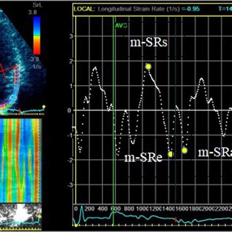 Left Atrial Strain Rate Download Scientific Diagram