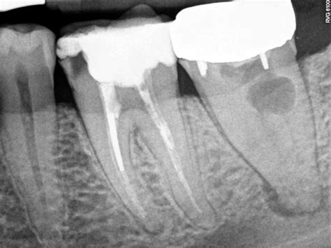 Root Canal System Calcifications Endomontreal