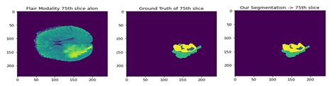 Github Ahmedsana Binary Class Brain Tumor Segmentation Using Unet We Segmented The Brain