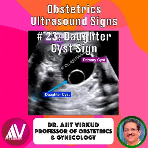 “daughter Cyst Sign — The Sonographic Hallmark Of Ovarian Follicular